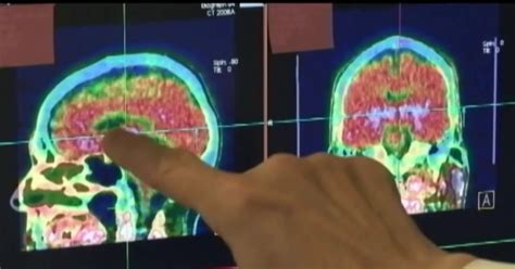La Fda Analiza La Aprobación Del Primer Medicamento Psicodélico Telemundo