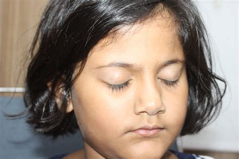 Full Recovery In Case Of Abcd Airborne Contact Dermatitis And Phrenoderma With Homeopathy