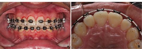 A Shift Greater Than 2 Mm Between Centric Occlusion And Maximum