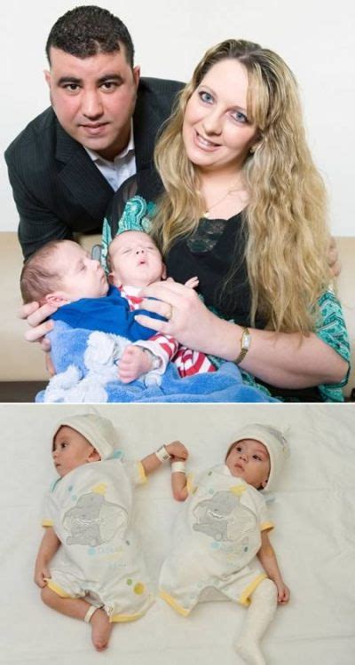 Fuck Yeah Conjoined Twins