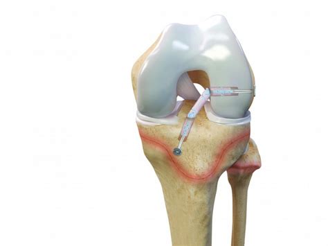 Fda Provides Clearance Of First Ever Device For Acl Reconstruction In