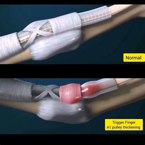 Trigger Finger A Unique Ultrasound Feature Youtube