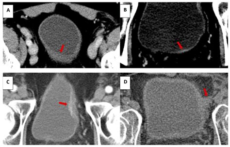 Visualization Of Intraluminal Bladder Mass By Time Before Pathologic Download Scientific