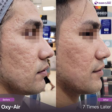 Acne Treatment Before And After Photos Siam Clinic Thailand