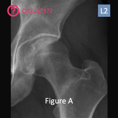 Orthobullets On Twitter Can You Answer This Daily Question From Our Free QBank Correctly QID