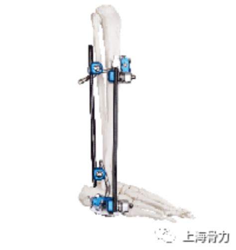 News External Fixation Bracket External Fixation Technique Of