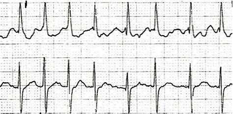 Atrial Fibrillation And Flutter UCLA Olive View Internal Medicine