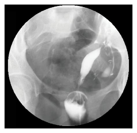 A Hysterosalpingogram Demonstrating Contrast Extravasation Through The