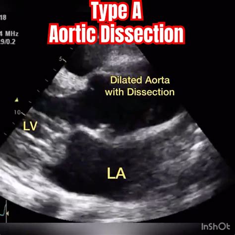 Type A Aortic Dissection On Echo Youtube