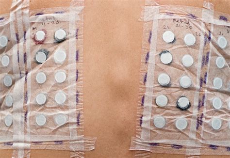 Patch test teste de contato é importante no diagnóstico de dermatites