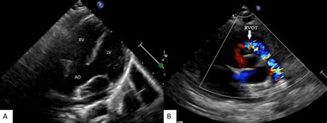 A B Long Axis And Modified Short Axis Transthoracic Download