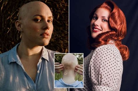 Alopecia Left Me Hiding Behind A Wig For 17 Years Now I Can Finally