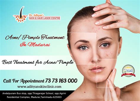 dr adityan will make your skin acne pimple free… by vetri maran