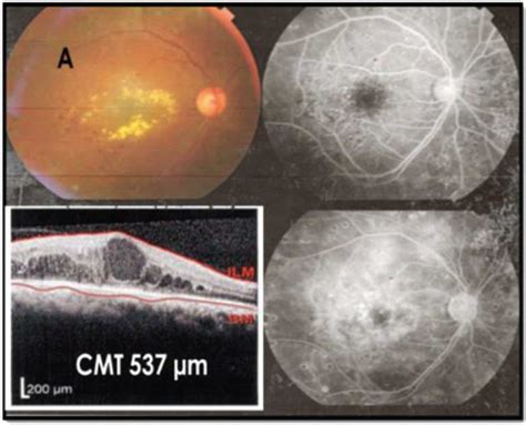 A Preoperative Color Fundus Photo And Fa Showing Diffuse Dme With