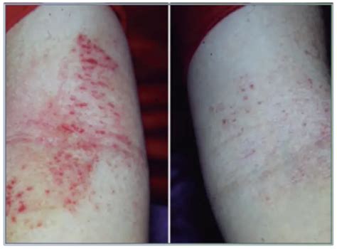 Eczema Endógeno En Dermatitis Atópica Campus Sanofi