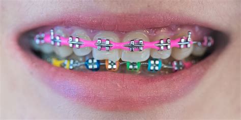 Black Braces A Comprehensive Guide To Modern Orthodontic Treatment