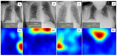 Suboptimal Chest Radiography And Artificial Intelligence The Problem