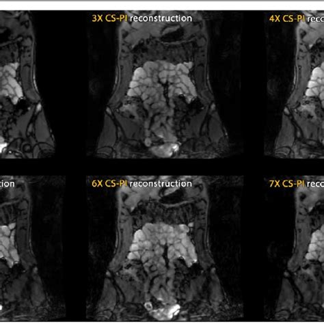 Compressed Sensing And Parallel Imaging Cs Pi Reconstructions From Download Scientific