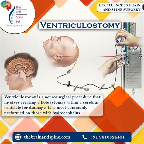 How To Set Up A Ventriculostomy Drain At Jonathan Boas Blog