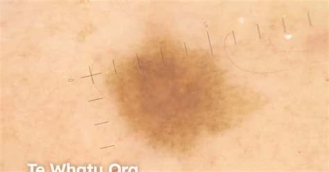 Melanocytic Naevus Image