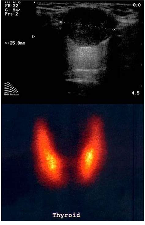 Ultrasonographic And Scintigraphic Patterns Of The Thyroid Nodule Download Scientific Diagram