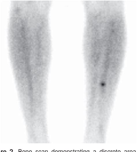 Figure 2 From Anterior Tibial Cortex Stress Fracture In A High Demand