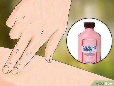 4 Ways To Get Rid Of Bug Bites WikiHow