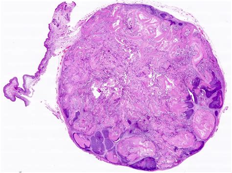 Pilomatricoma Histology