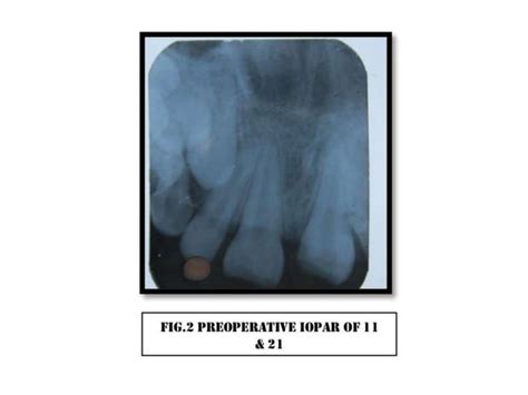 A Case Of Cvek Pulpotomy With Mta Ppt