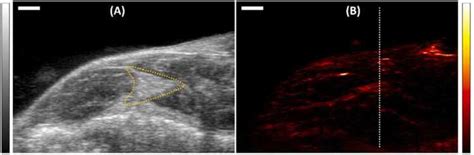 Superpixel Spectral Unmixing Framework For The Volumetric Assessment Of Tissue Chromophores A