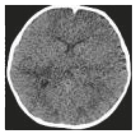 A No Stroke B Stroke C Hyperacute Stroke D Ischemic Stroke