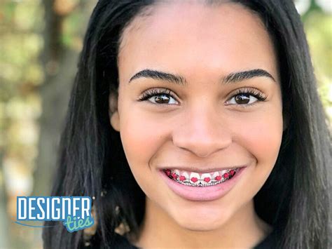 Red Colored Braces