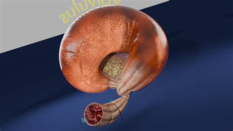 Volvulus Intestine Obstruction Superhive Formerly Blender Market