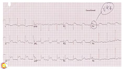 Module 5 Tips And Tricks Stemi Ecg Recognition And Patterns Finale Pdf