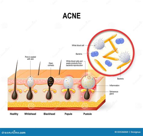 Acne Vulgaris Or Pimple Stock Vector Illustration Of Formation 83536068