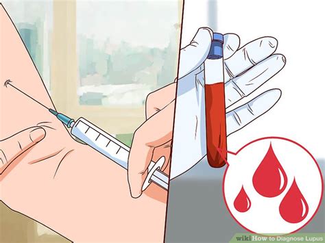How To Diagnose Lupus With Pictures Wikihow