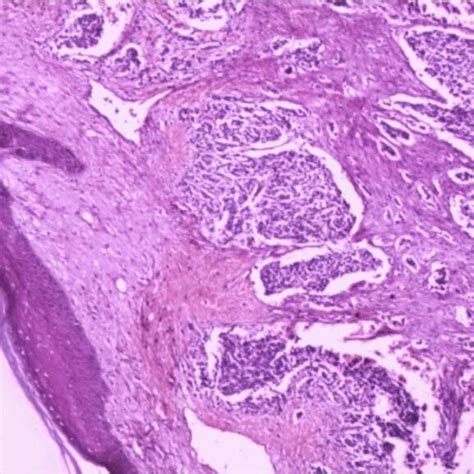 Photomicrograph Showing Surface Squamous Epithelium Subepithelial