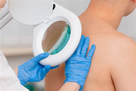 Causes And Risk Factors For Cutaneous T Cell Lymphoma