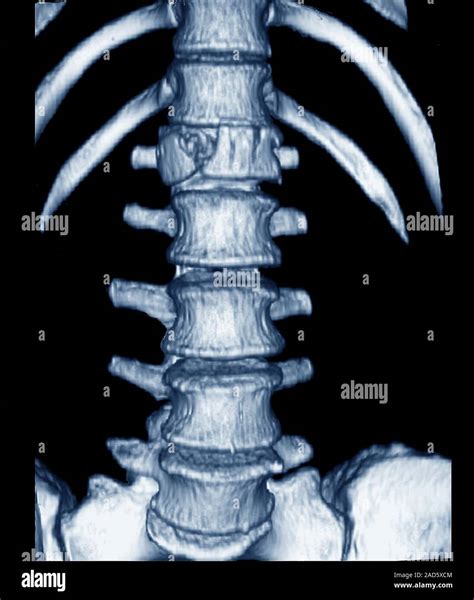 Fractured Vertebra Coloured 3D Computed Tomography CT Scan Image Of