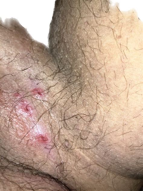 What Are These Bumps On In My Groin Region R Dermatologyquestions
