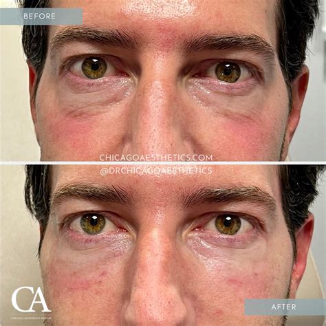 Dermal Fillers Before After Chicago Aesthetics Med Spa