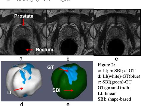 Figure 2 From Shape Based Interpolation Of Mri Volumes In Trus Fusion