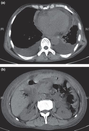 Computed Tomography Ct Scan Of The Chest Showing Massive Bilateral