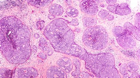 Près De 10 Millions De Morts Dans Le Monde En 2018 à Cause Des Cancers