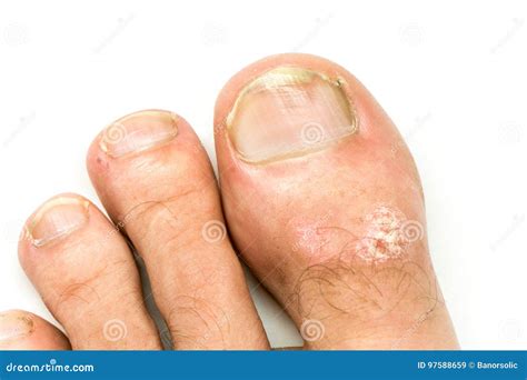 Psoriasis Vulgaris On The Mans Hands With Plaque Rash And Patches On