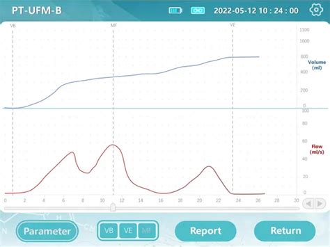 Equipment Used In Urology Pc Serie1100ml Normal Uroflowmetry Graph Male For Sale Uroflowmeter