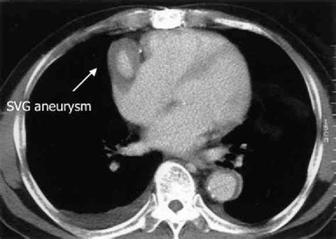 Figure 1 From Large Saphenous Vein Graft Aneurysm With A Fistula To The