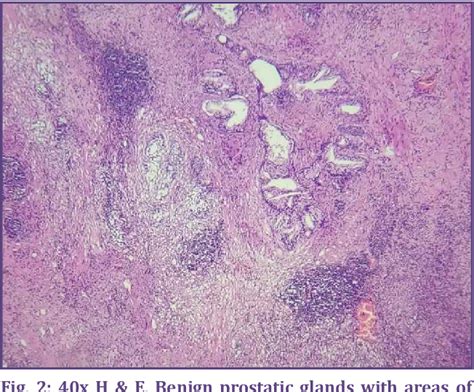 Figure 2 From A Case Of Malakoplakia Mimicking Prostatic Malignancy Semantic Scholar