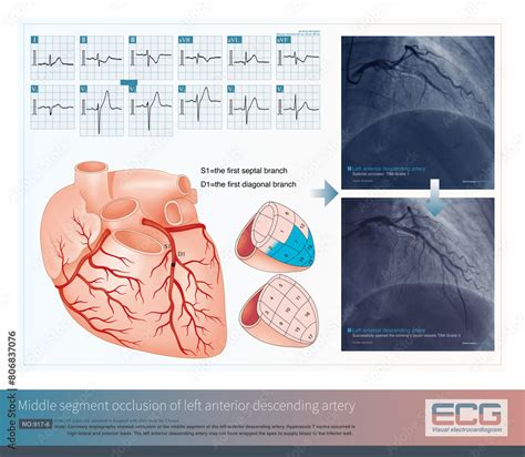 Male 65 Years Old Was Clinically Diagnosed With Acute Anterior