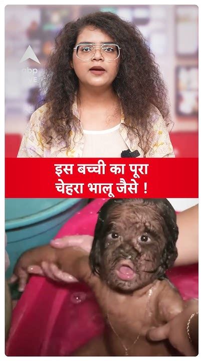Werewolf Syndrome Malaysia की बच्ची Hypertrichosis नाम की बीमारी से